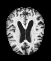 Alzheimer disease Classification Model by Alzheimers