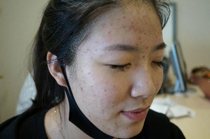 Face Skin Problems Object Detection Model by Dental Caries
