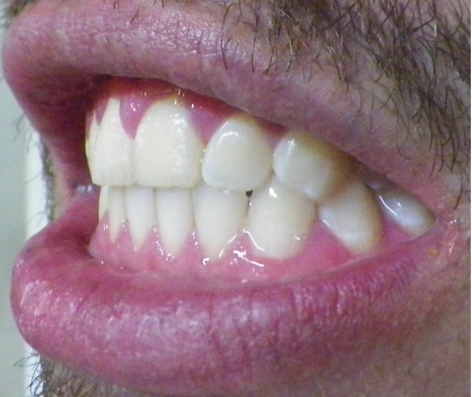 Dental Caries Object Detection Dataset By Dental Caries