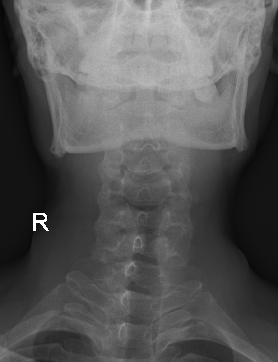 spine_frx_normal_vindr Object Detection Dataset by spine1000