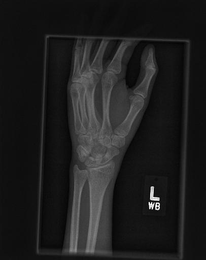 bone fracture Object Detection Dataset by SkinCancerResearch