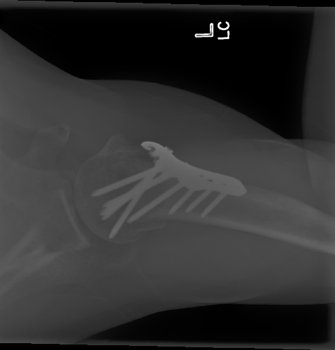 shoulder Object Detection Model by SkinCancerResearch