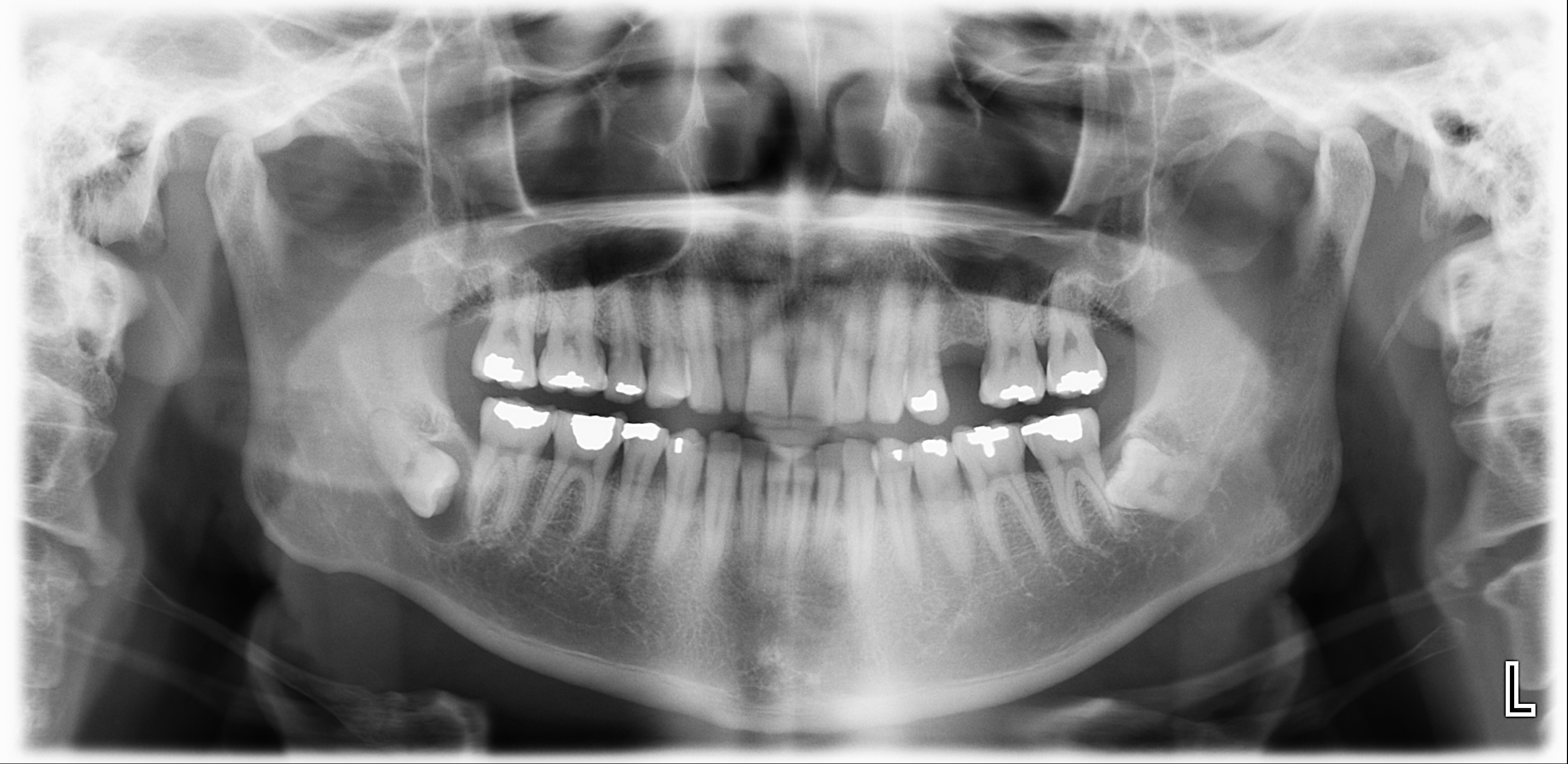 teeth detection_u.bone Object Detection Model by teeth