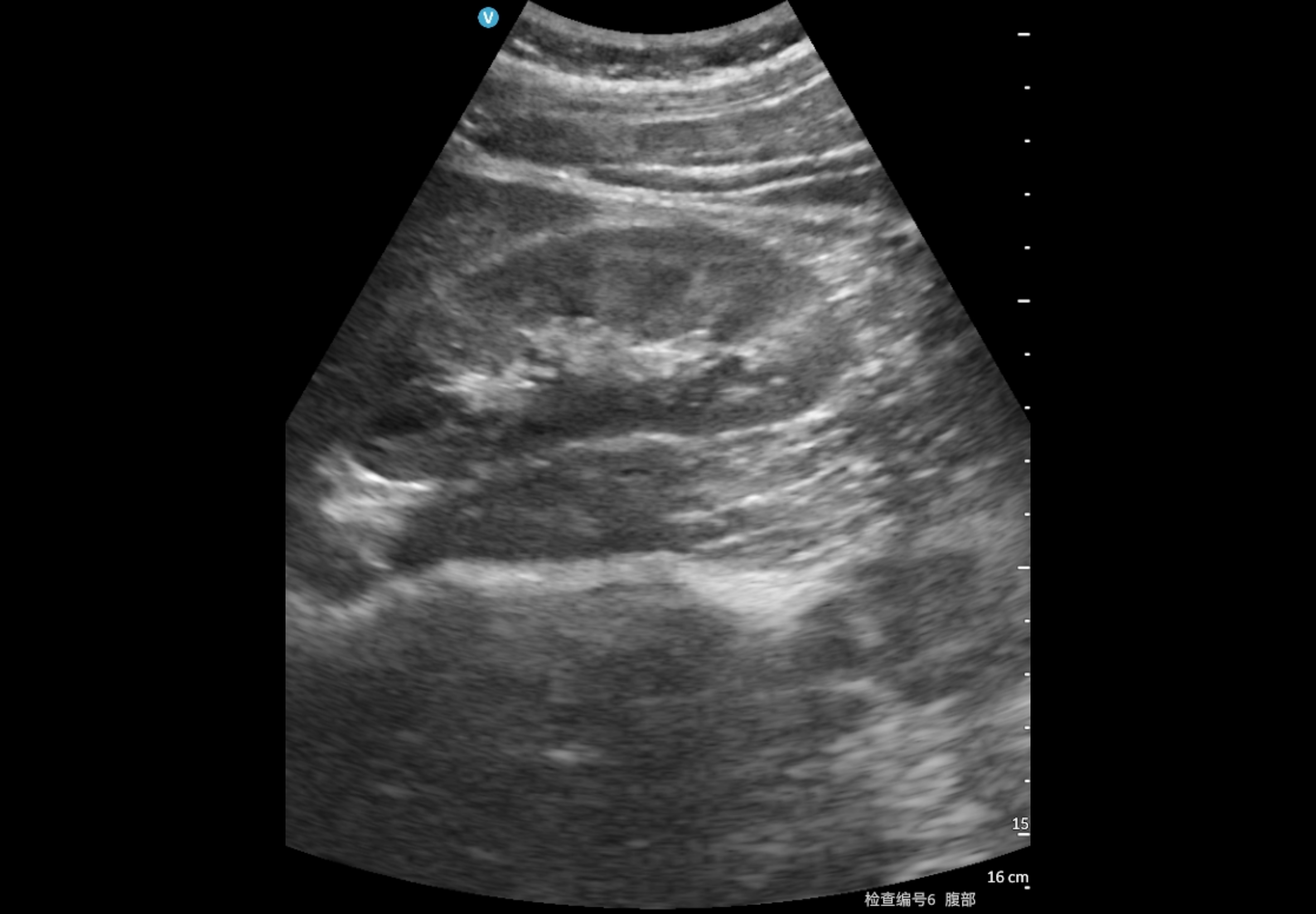 kidney ultrasound Object Detection Model by test