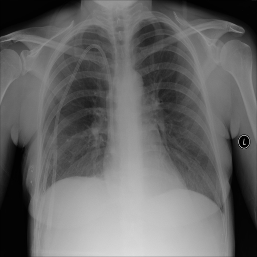 Tuberculosis CLassification Classification Model by FYP PROJECT