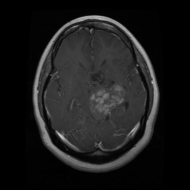 Brain Tumor Segmentation Instance Segmentation Dataset By Reninda