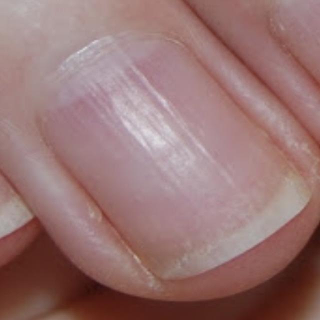 Normal nail Object Detection Dataset by MIST