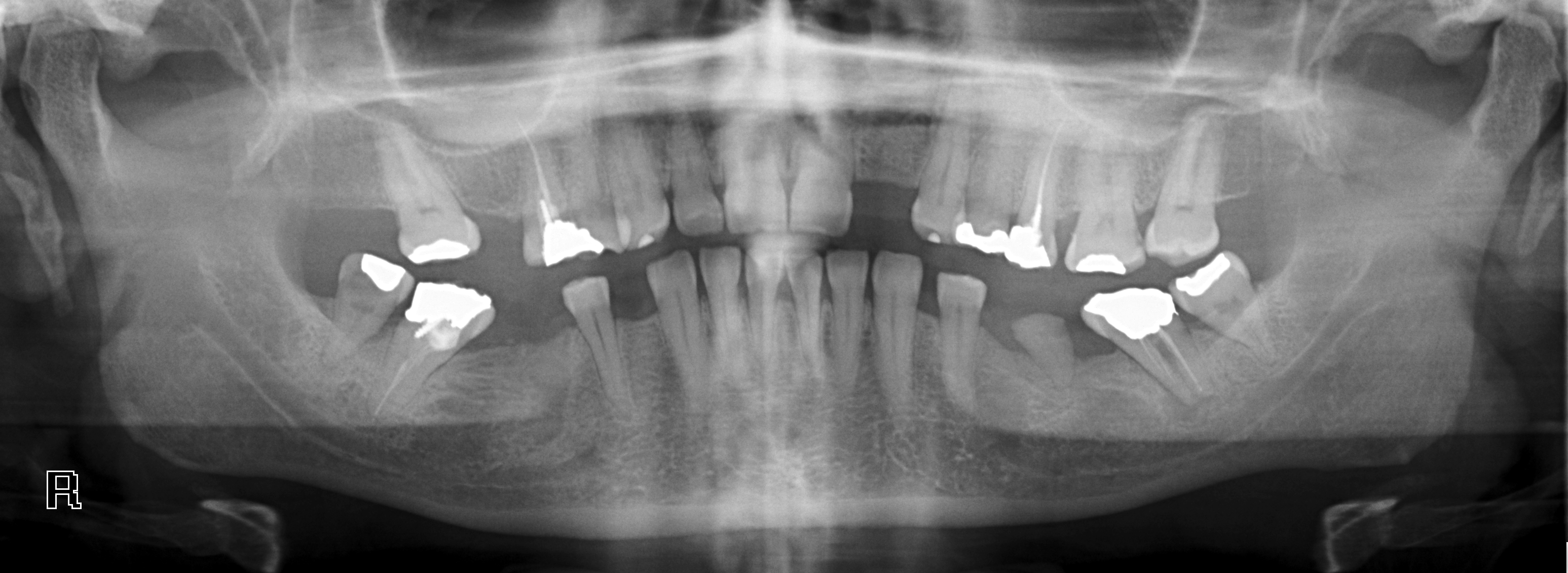Tooth Label in Panoramic X-ray Semantic Segmentation Model by Machine ...