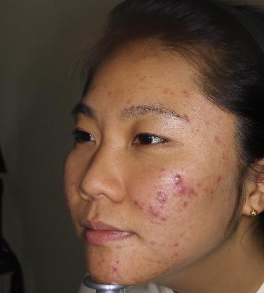 Facial Skin Object Detection Dataset by acne service image