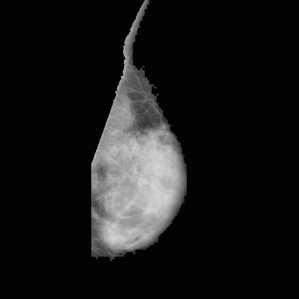 Mini MIAS (YOLO) Object Detection Dataset by Density classification