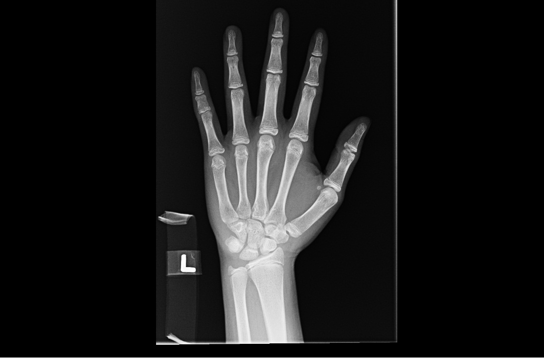 hand xray Object Detection Dataset by hand xray