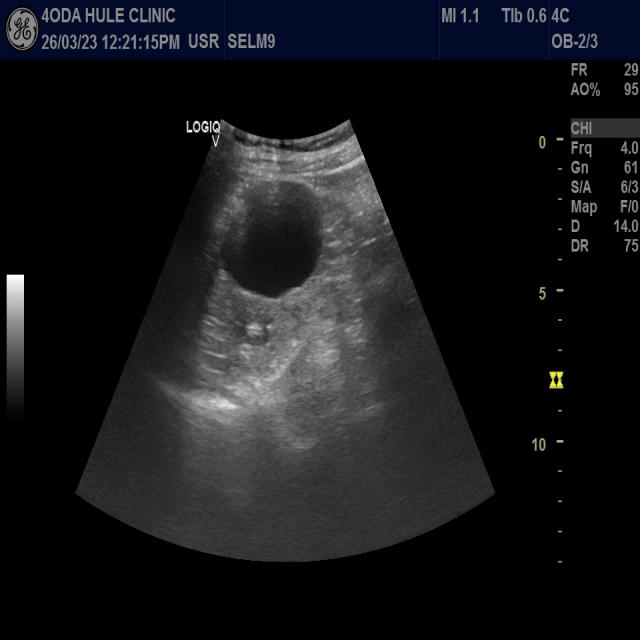 kidney-stone-ultrasound Object Detection Model by Radiulogy