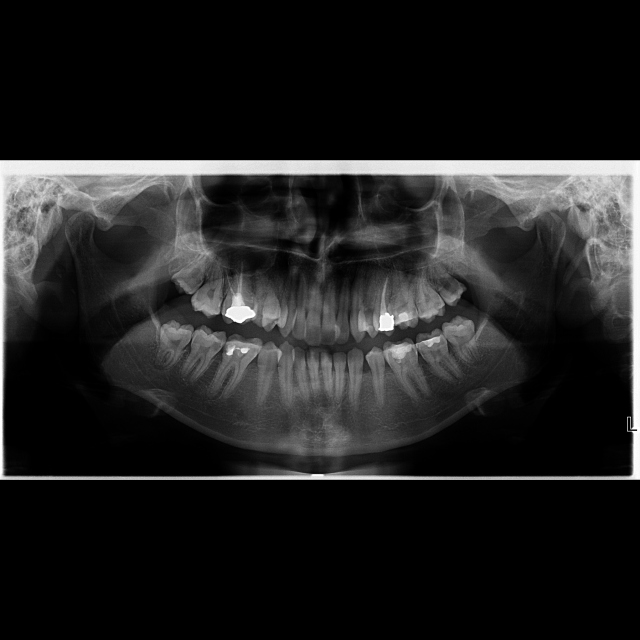 Dental_caries_panaromic_x_rays Object Detection Dataset and Pre-Trained Model by cariesdetection