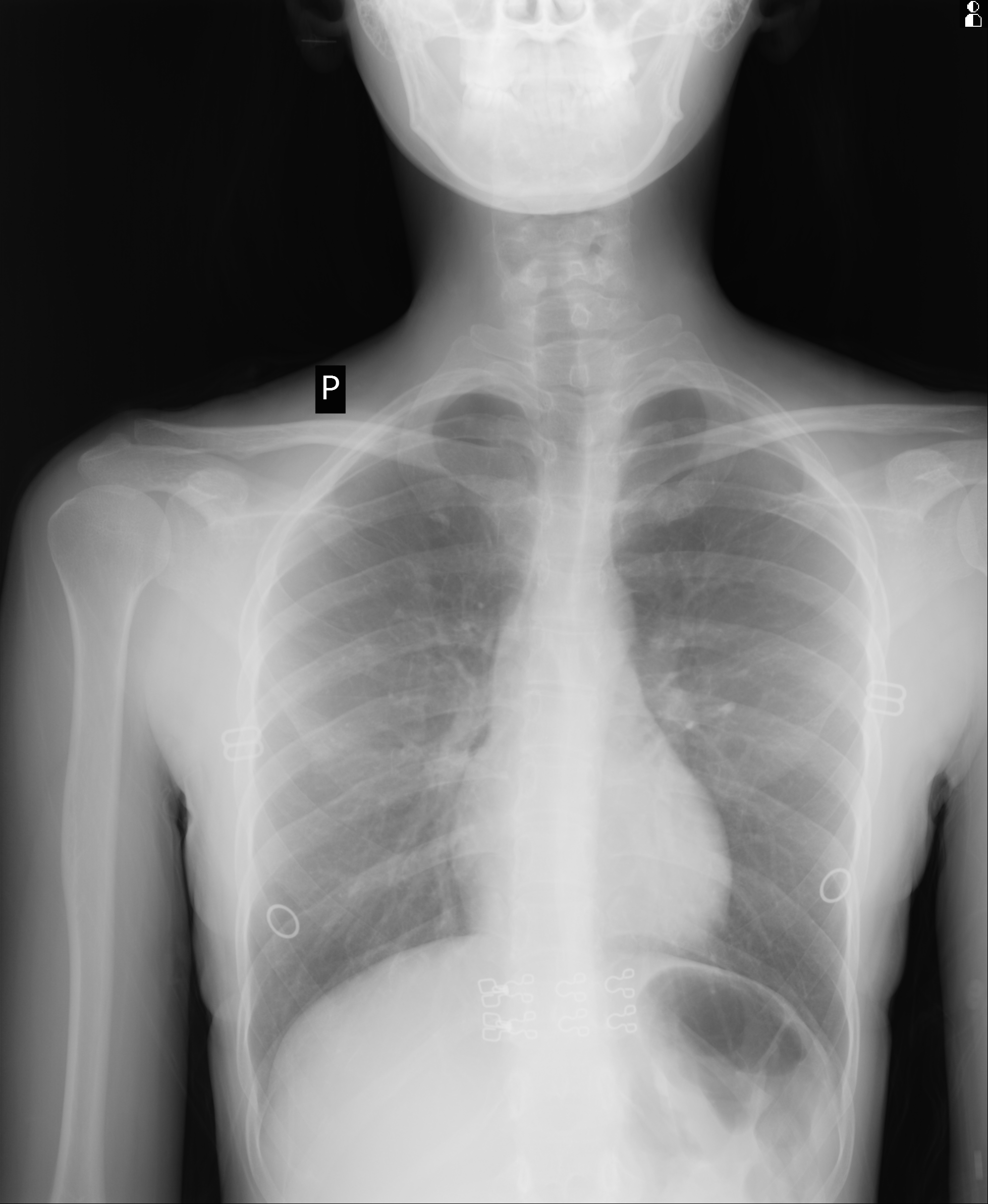 Chest Xray Symptom Detection Object Detection Dataset V3 2025 06 11 11 24pm By