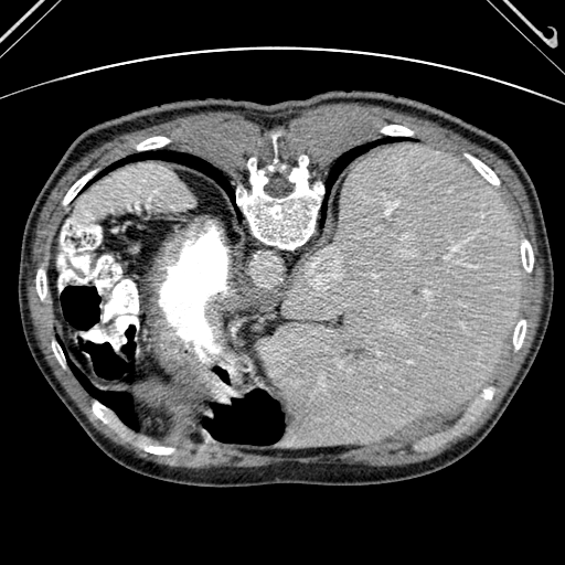 Slice_Muscle_Segmentation Instance Segmentation Dataset by capstone2024