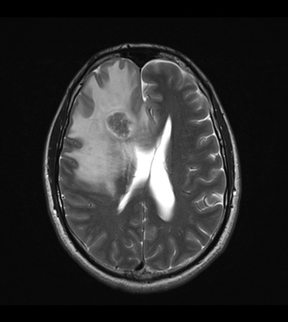Brain Scan MRI Object Detection Dataset and Pre-Trained Model by ...