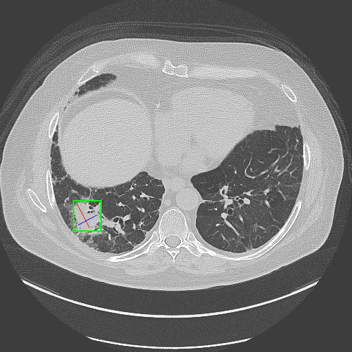 lungdataset Classification Model by Lungcancer