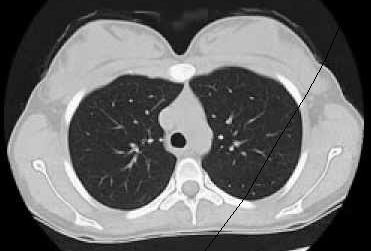 Lung cancer DATASET Classification Model by Lungcancer