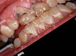 dental caries Object Detection Dataset and Pre-Trained Model by Rohit