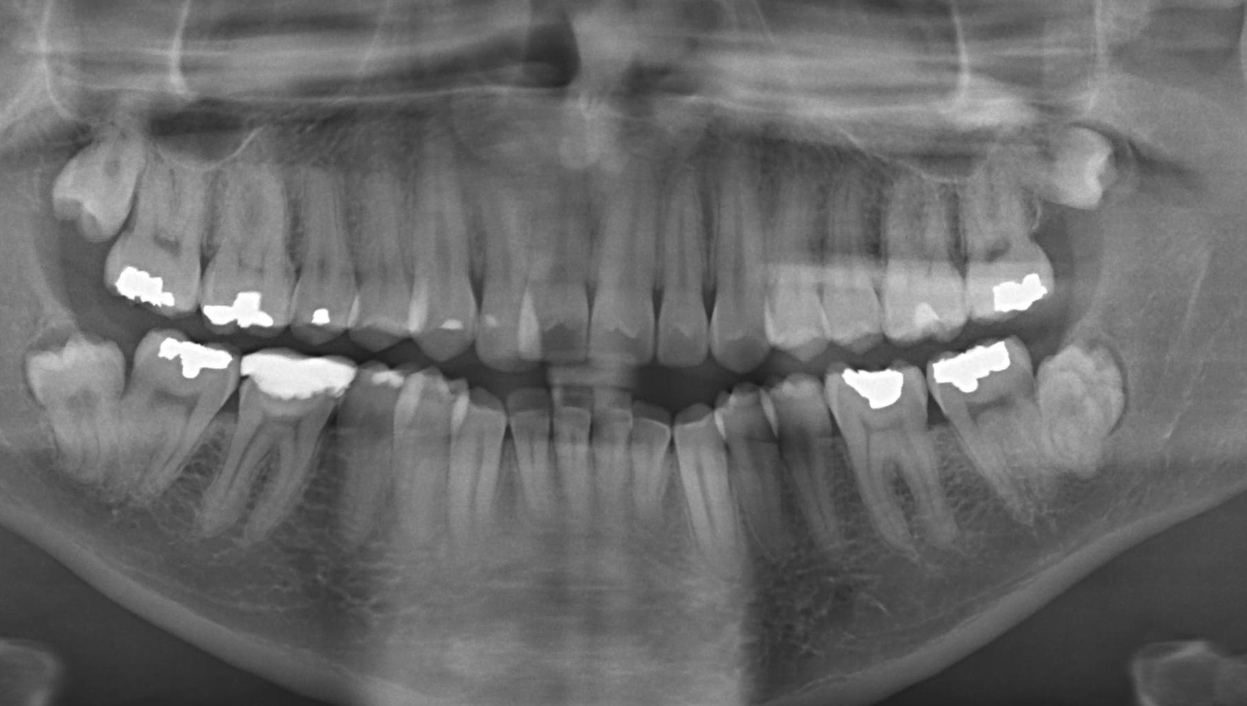 Teeth_Identification Object Detection Dataset by SAEED ALQARNI