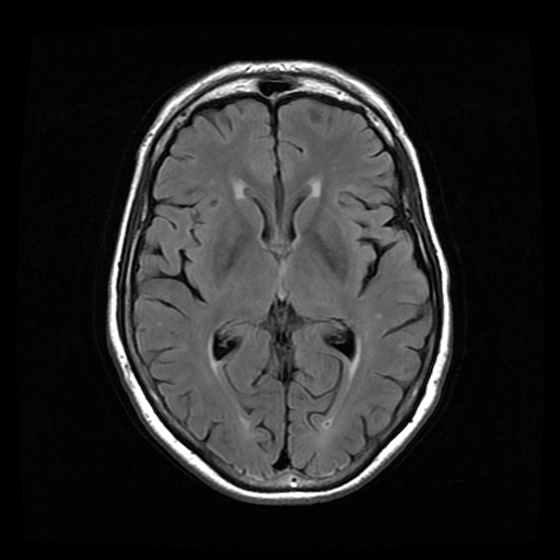 Middle Brain Instance Segmentation Dataset by Parkinson