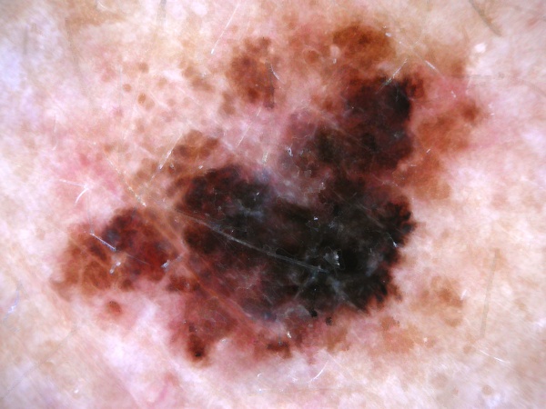 ham10000-skin-lesions-annotation Instance Segmentation Dataset by ...