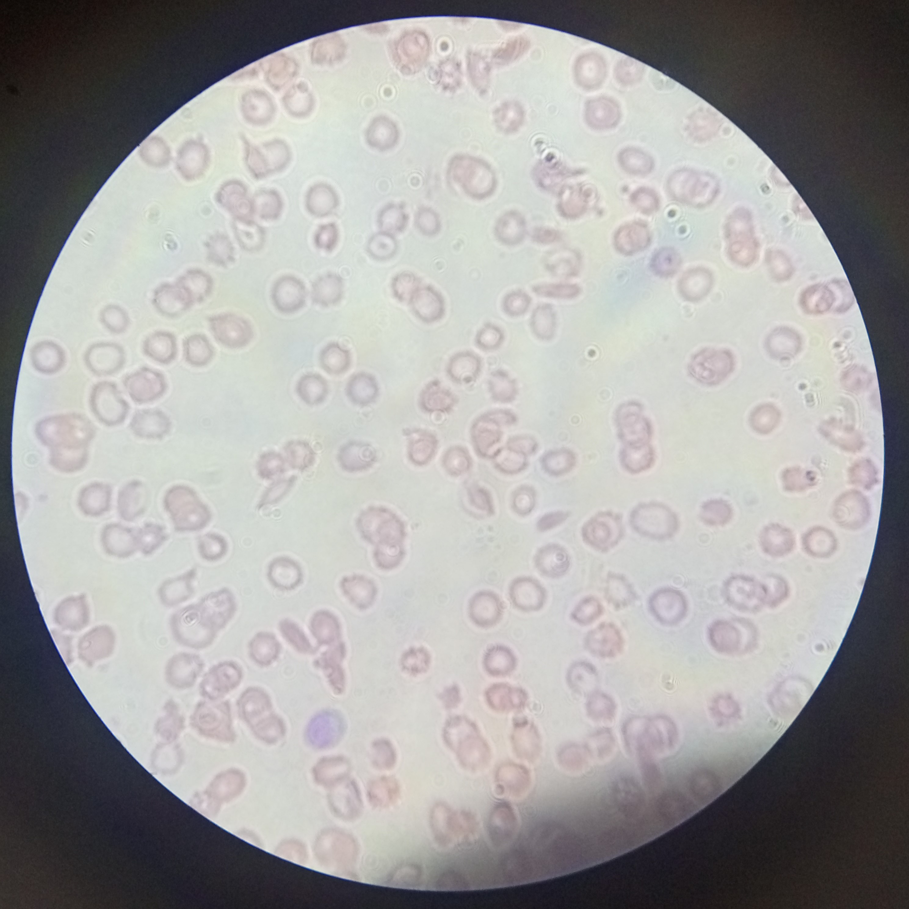 Sickle cell detection Object Detection Dataset and Pre-Trained Model by sickle cell