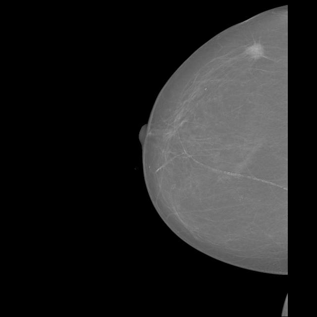 INBREAST Object Detection Model (v3, 2024-12-06 2:33pm) by hsny91