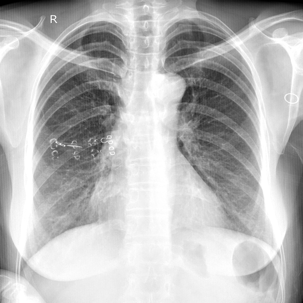 Xray Detection Object Detection Dataset By Kmati