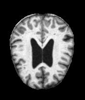 Alzheimer Classification Model by Alzheimer