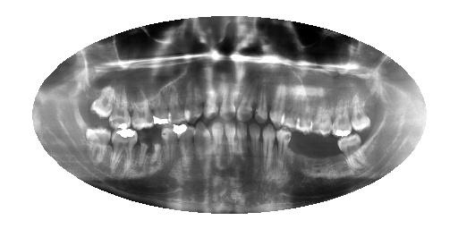Yolo_penaromic_xray Object Detection Dataset by dental