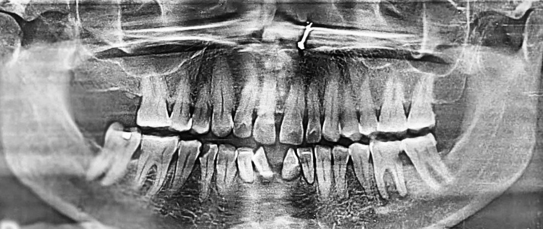 New Opg Dataset Object Detection Dataset By Dental