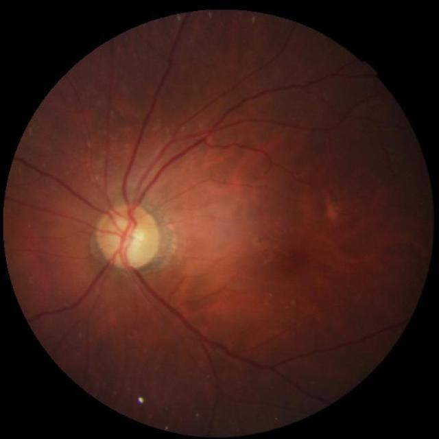 drusen Instance Segmentation Dataset by shehan