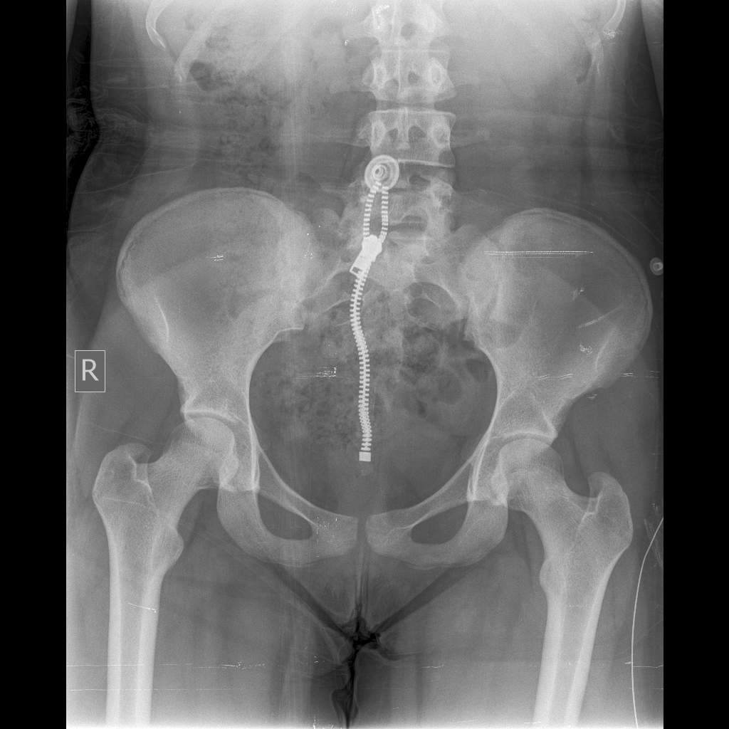Stones_where_are_you? Instance Segmentation Model (v3, 2024-08-07 11:49am) by XRay Abdomen to ...