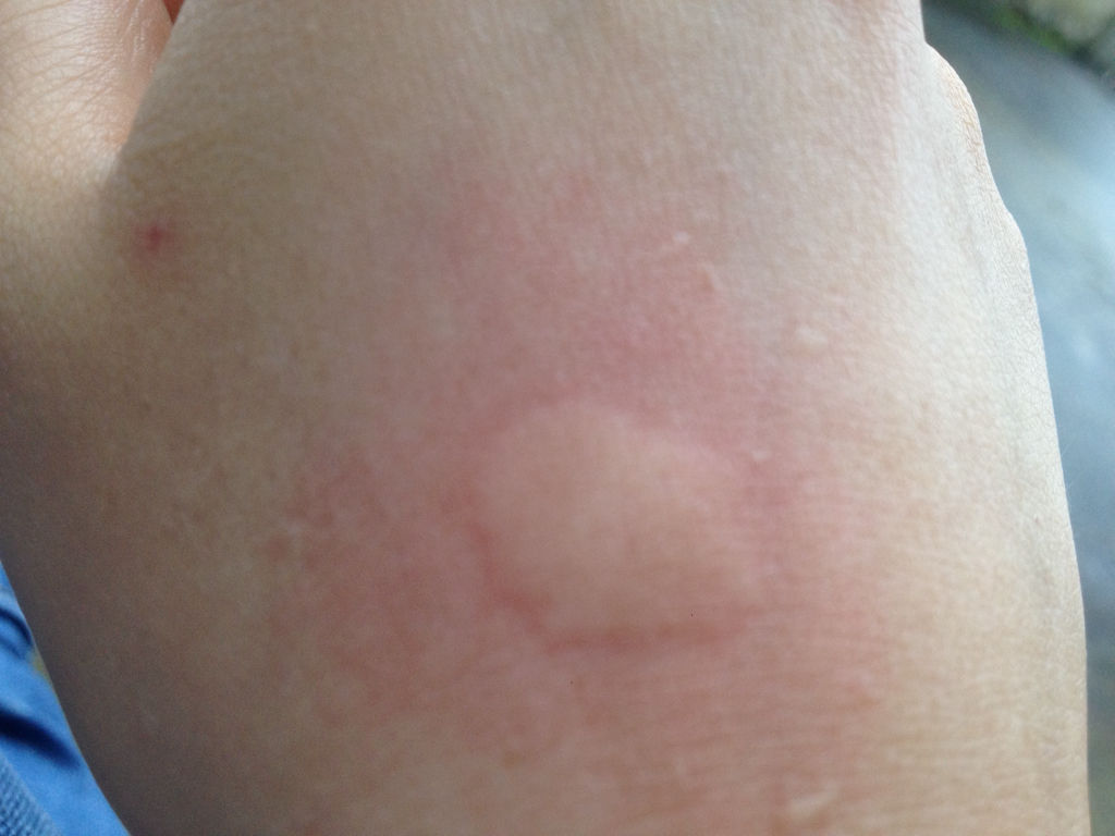 bug bites Object Detection Model by bug bites