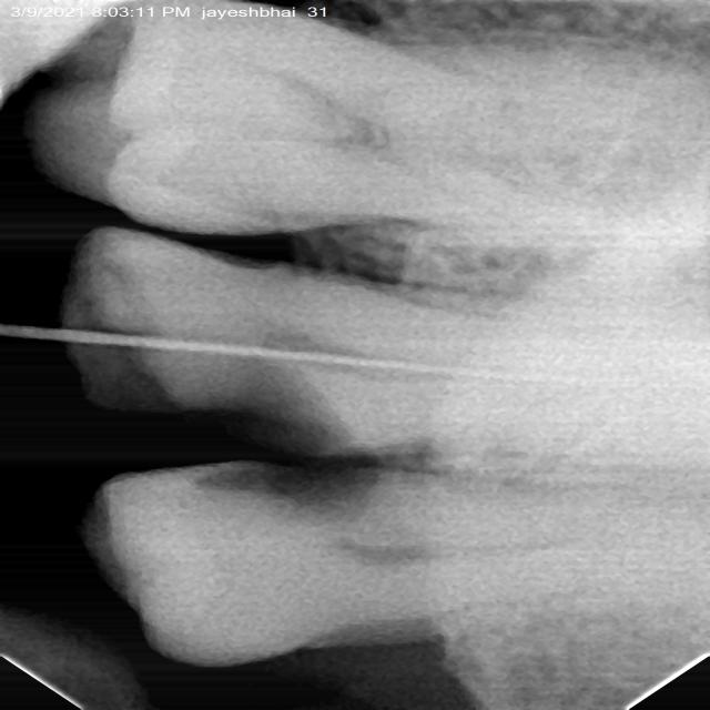Cavity Detection Object Detection Dataset And Pre Trained Model By Mango Detection And Counting