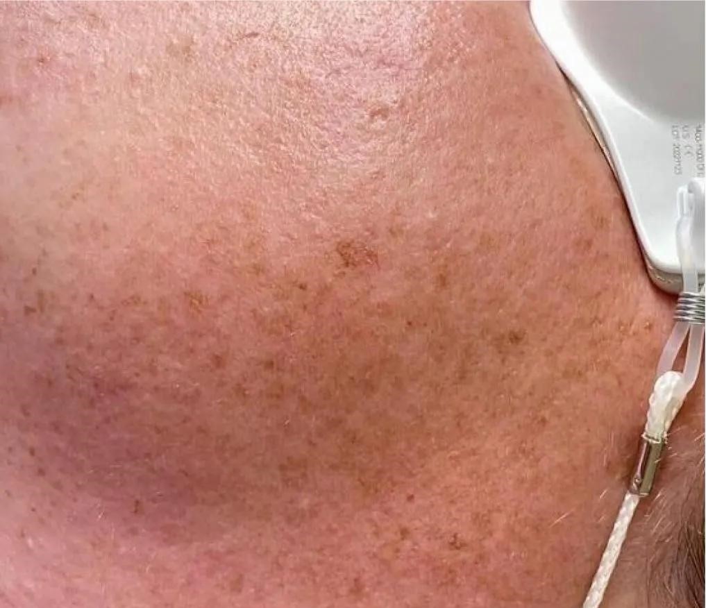 skin Object Detection Model by yolov11dataset