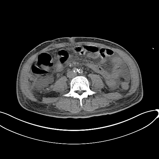 NS CT_image Object Detection Model by NF CT images