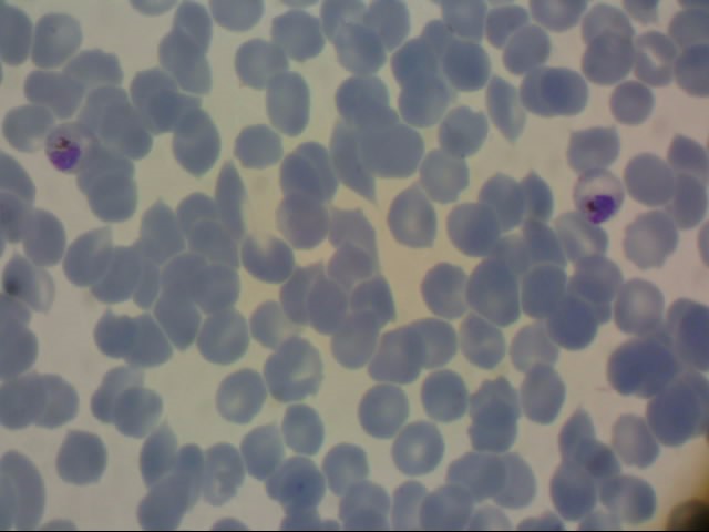 RBC MALARIA Instance Segmentation Model by Firza Ichlasul Amal Ariansyah