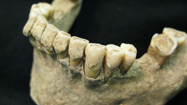 Dental Caries Detection Object Detection Model By Dental Caries Detection Using Yolov8