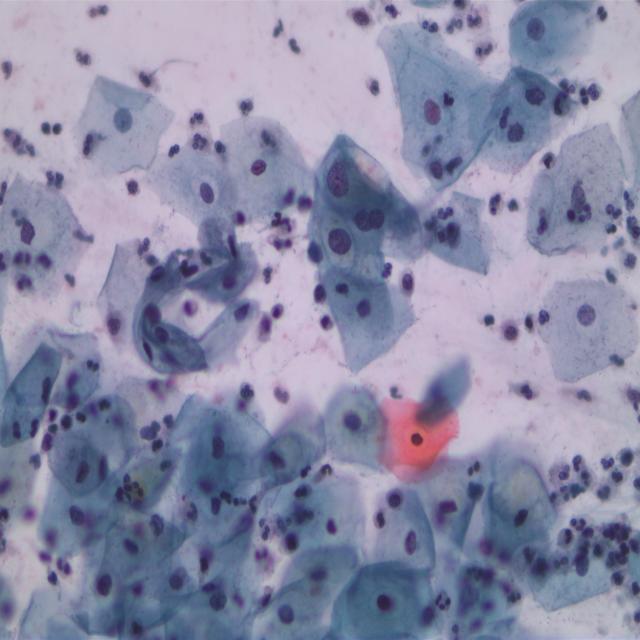 Cervical Cancer Segmentation Instance Segmentation Dataset And Pre Trained Model By Computer