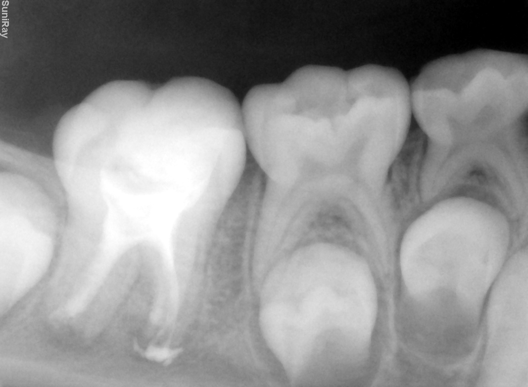 teeth predictions from model Instance Segmentation Dataset by project