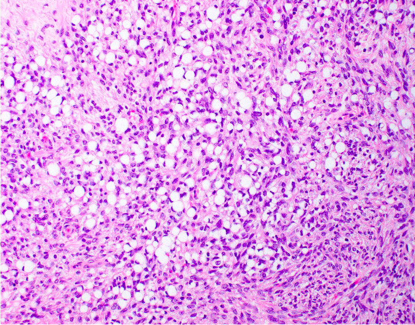 OVARIAN CANCER BIOPSY ANALYSIS Classification Model by SWU PHINMA SOM