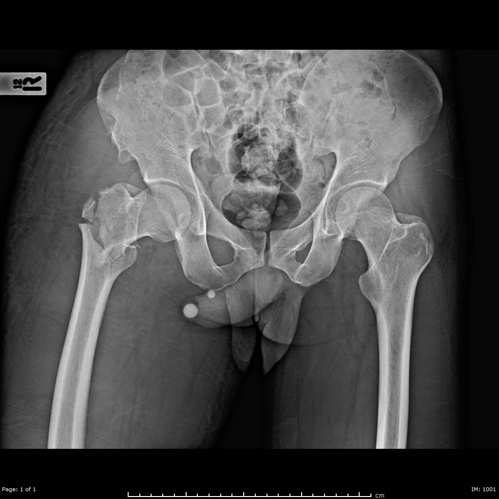 validate_set_hip_bone Object Detection Dataset by indiect validate_set_hip_bone Object Detection Dataset by indiect