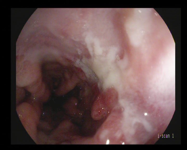 Esophageal Cancer Object Detection Dataset by Sam Vish