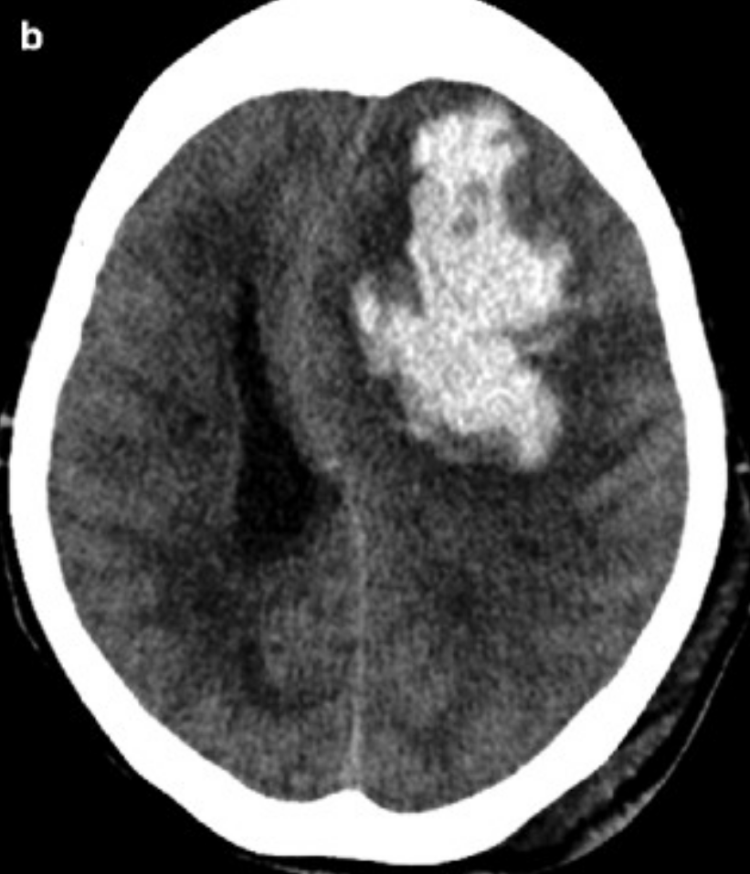 Head ct Object Detection Dataset and Pre-Trained Model by CT Medical Images