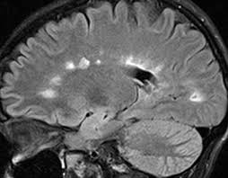 Tumor Detection Object Detection Dataset by Lab4