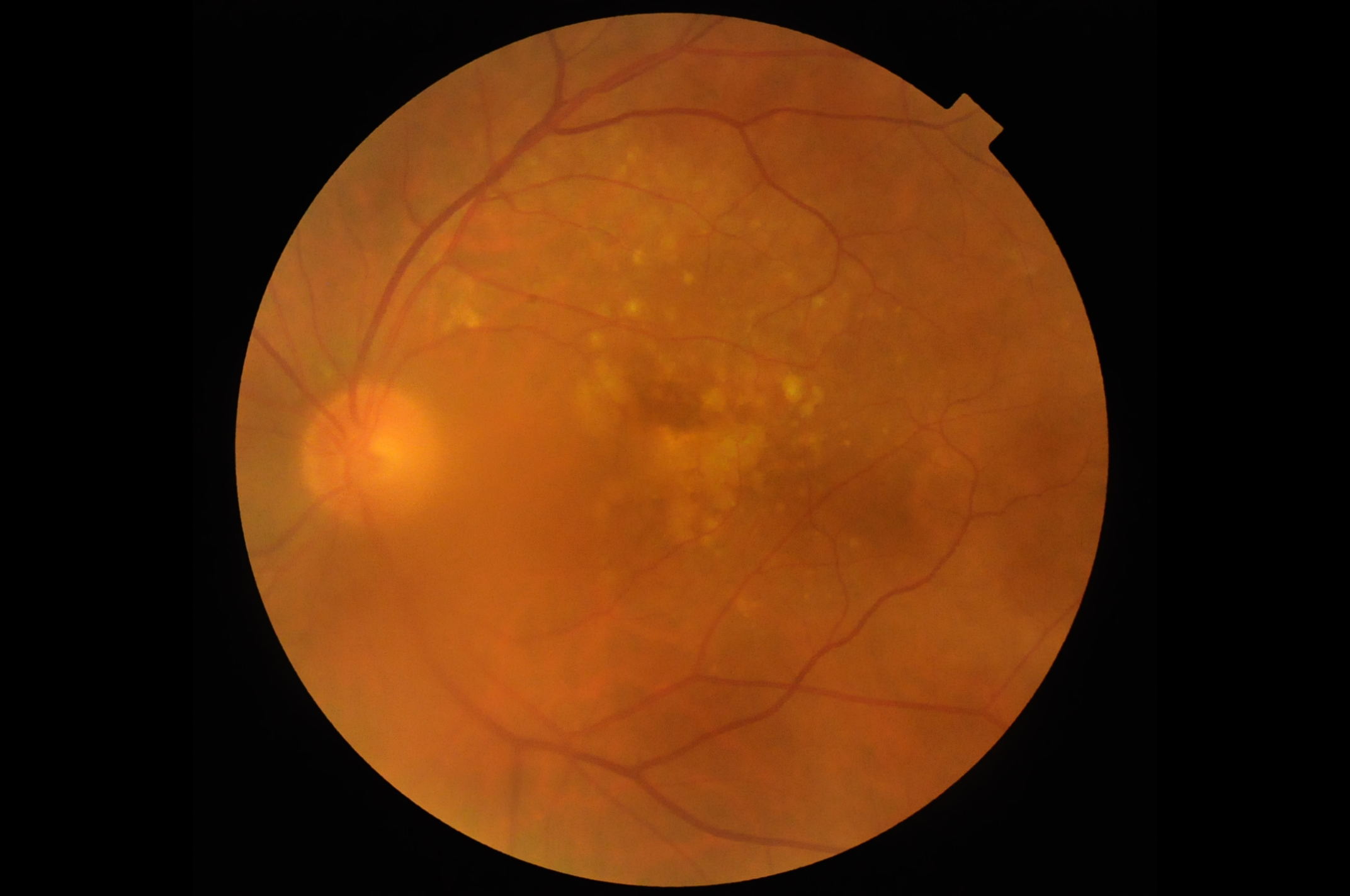 Macular Degeneration Object Detection Dataset By Bvod