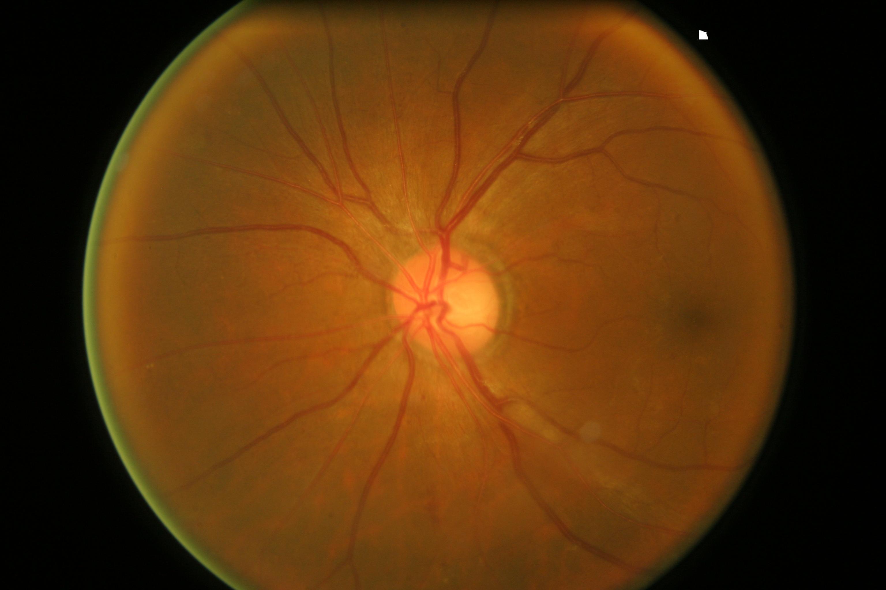 Glaucoma detection Classification Dataset by Glaucoma