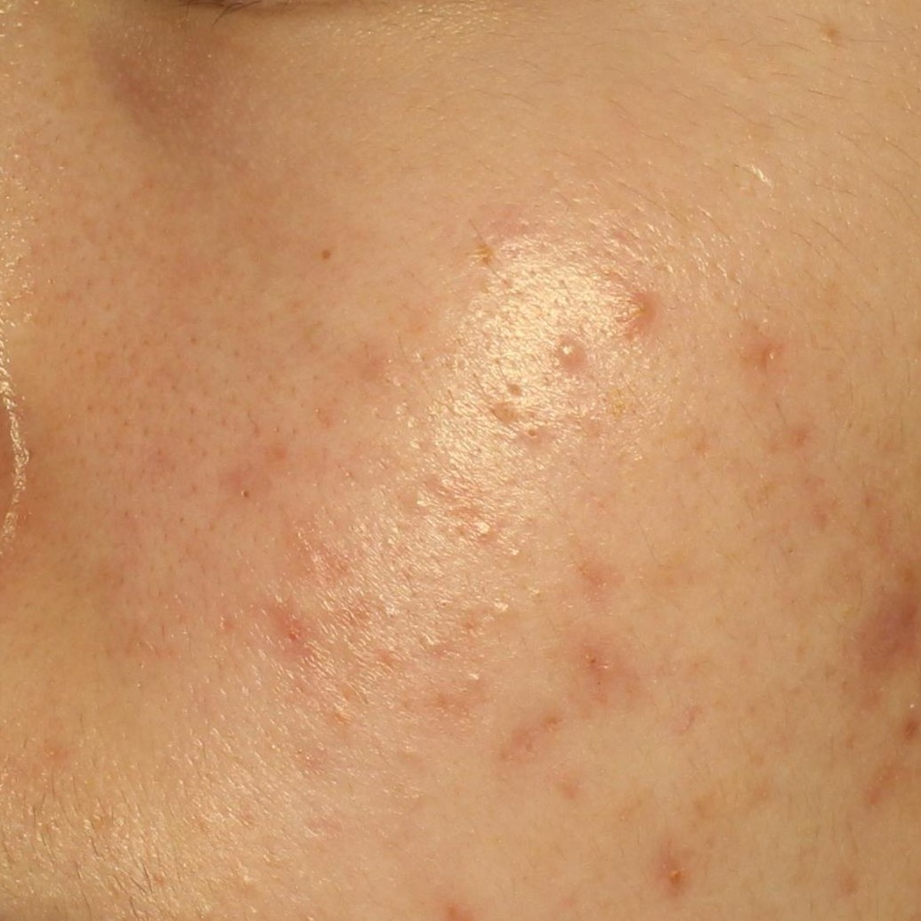 acne-trainer Object Detection Dataset by acnetrainer